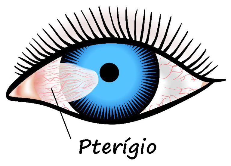 Tratamento do Pterígio: entenda o que é o pterígio, formas de ...