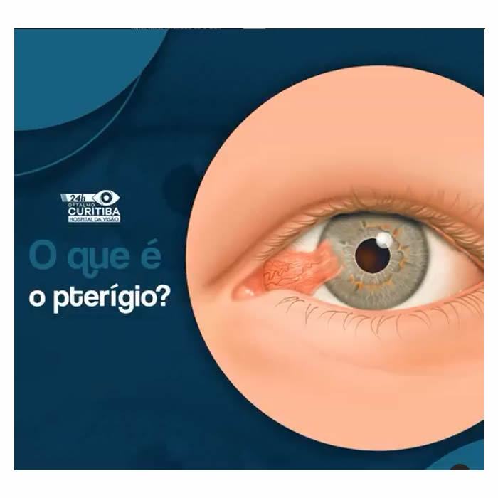 O que é pterigio? Causas e tratamento em Curitiba | Hospital da Visão ...
