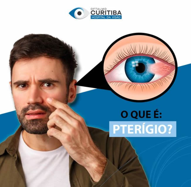 O que é pterígio? Causas e tratamento em Curitiba | Hospital da Visão ...